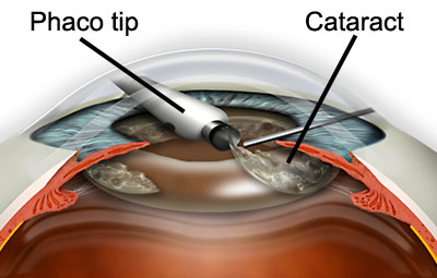 Phaco Surgery in Delhi | Cataract Removal in India